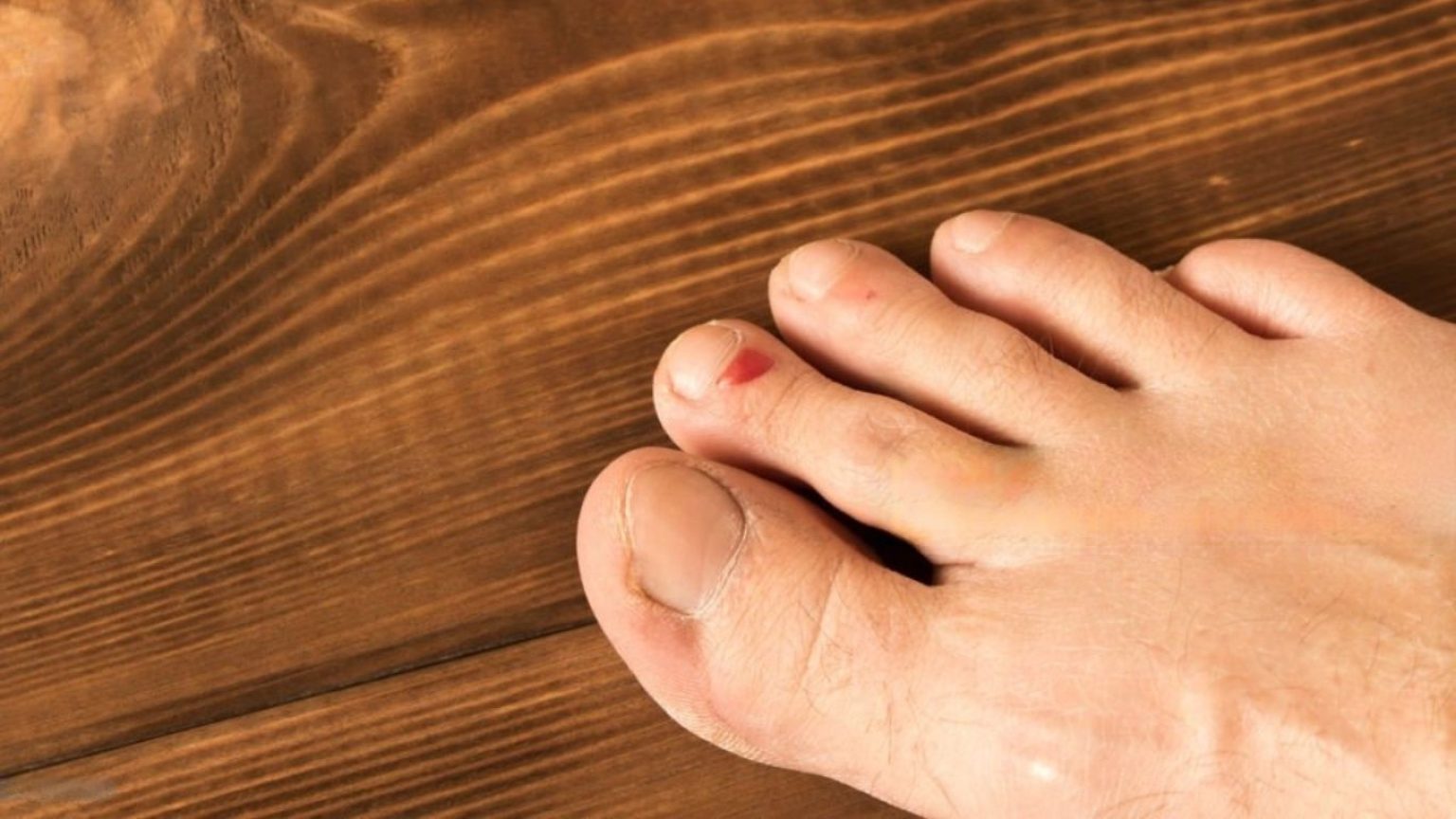 How to Treat Pinky Toe Blisters: Treating Pinky Toe Blisters ...